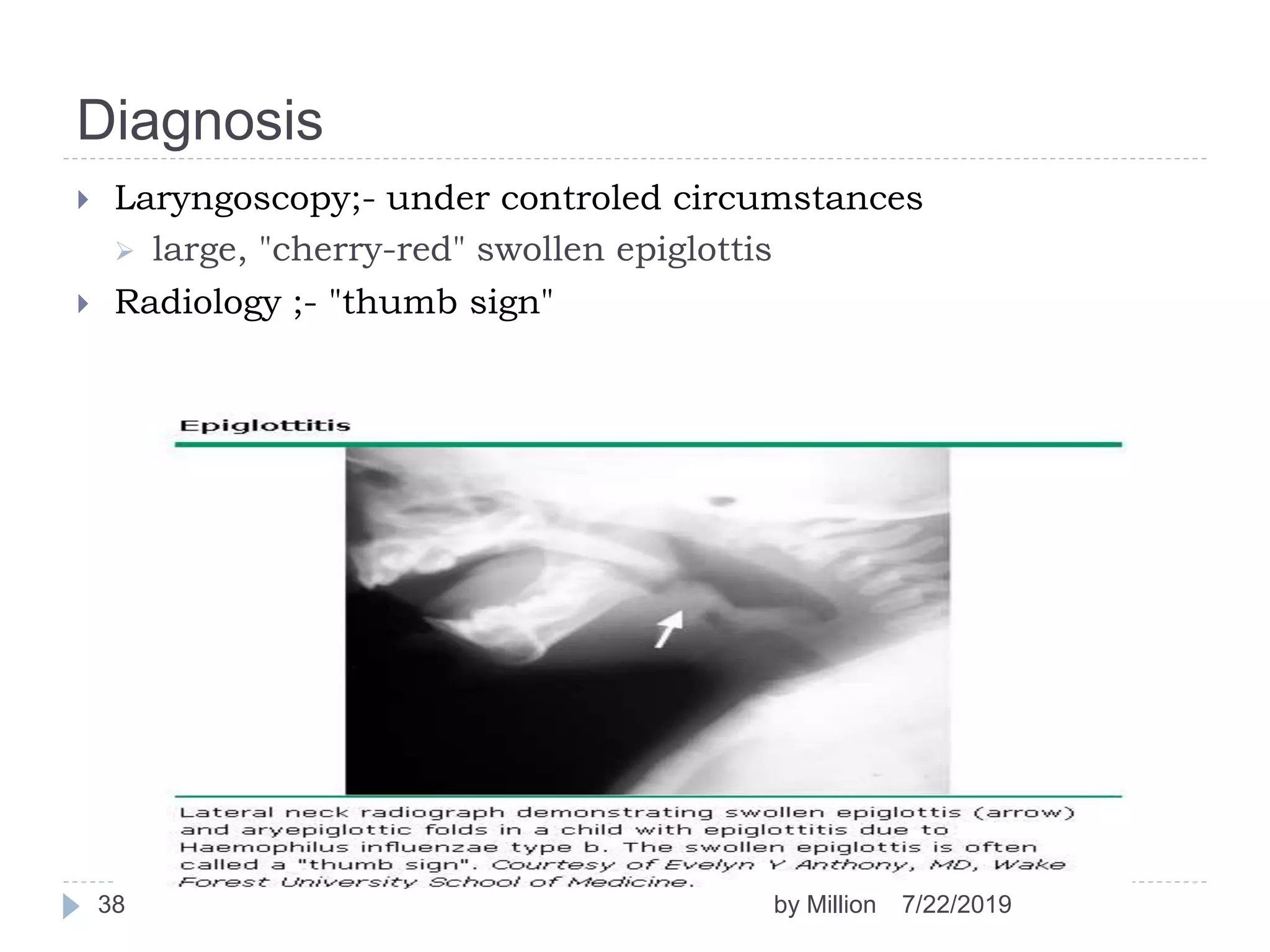 pediatric air way obstruction | PPTX
