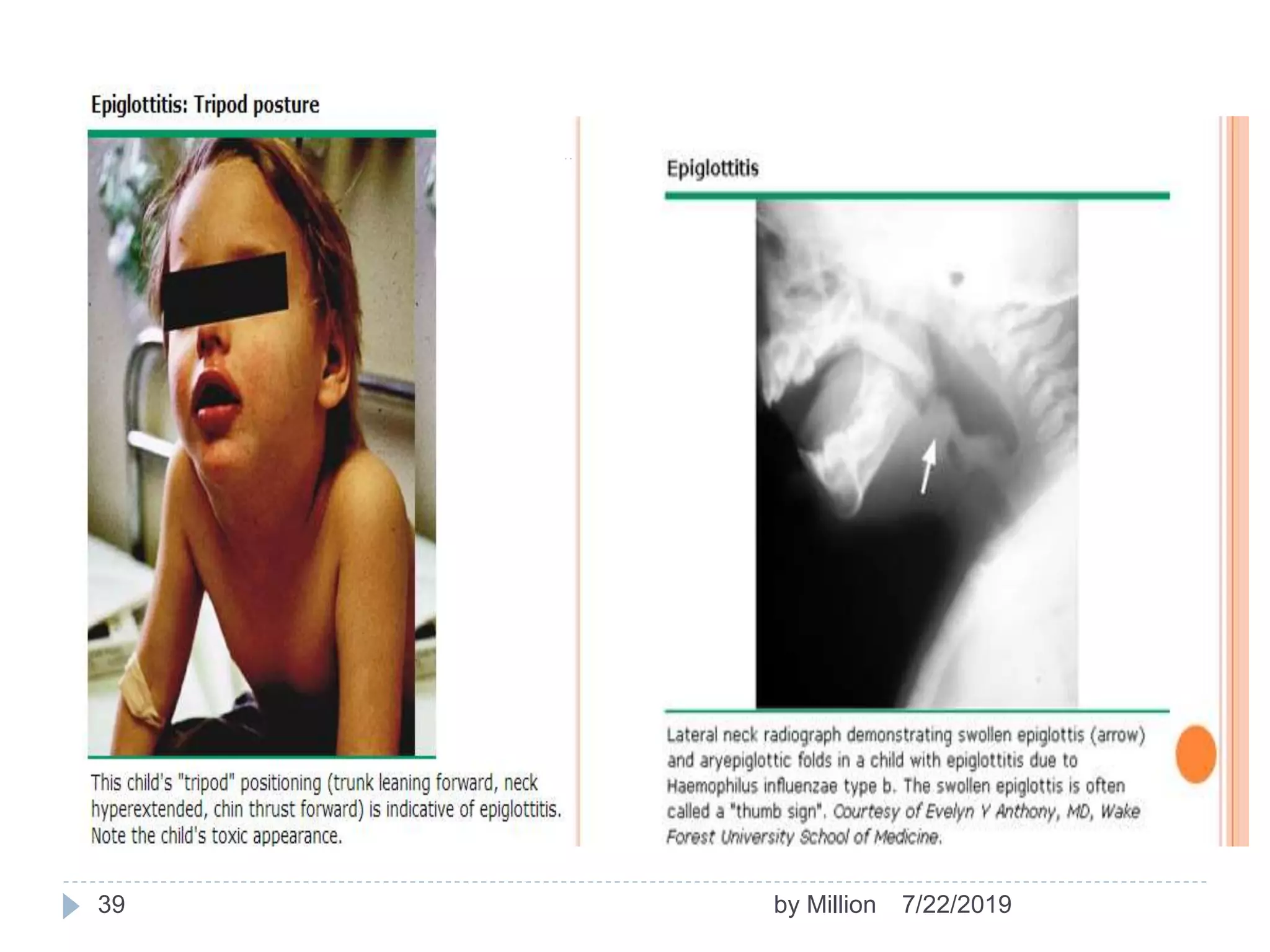 pediatric air way obstruction | PPTX