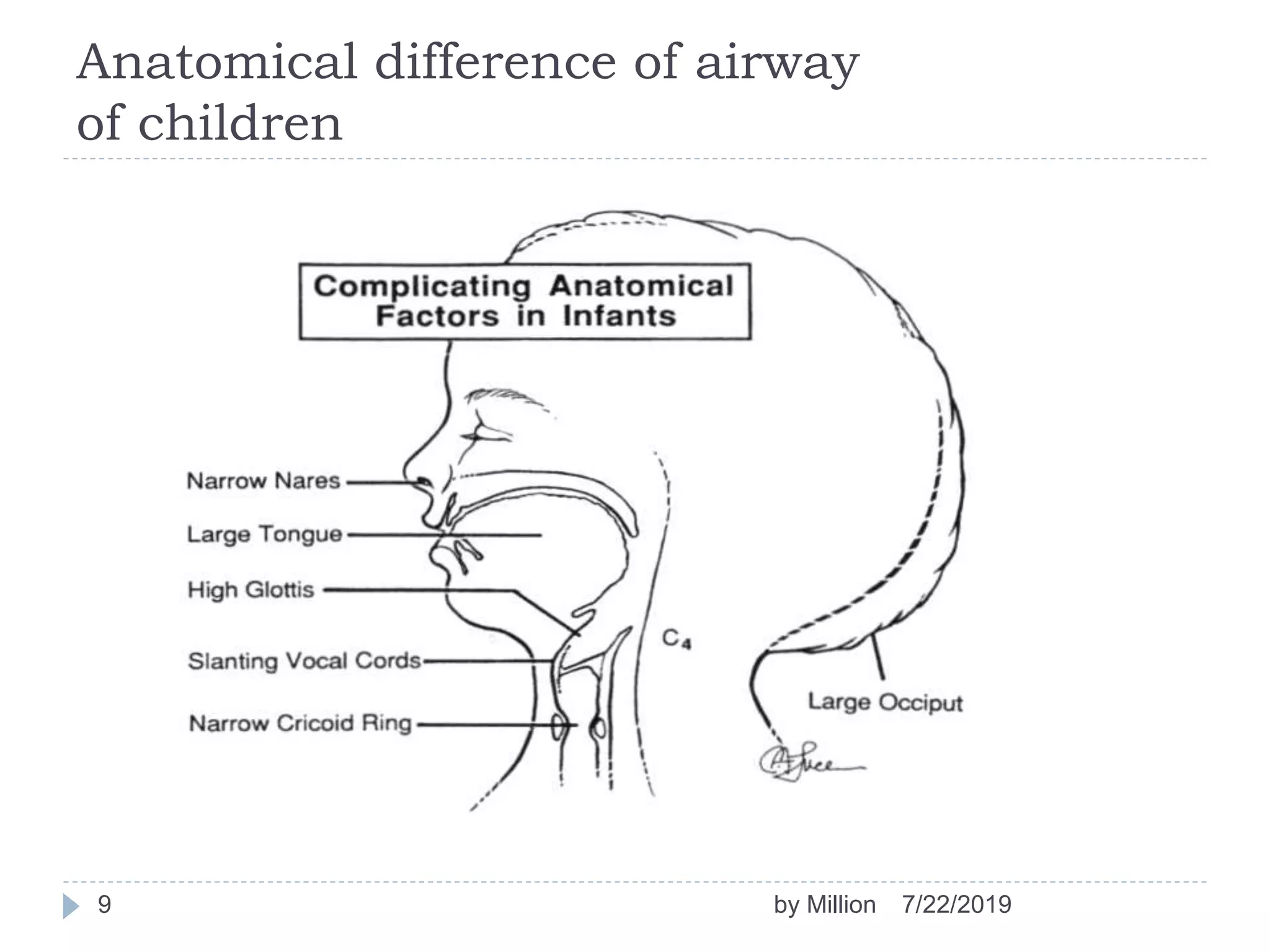pediatric air way obstruction | PPTX