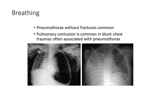 pediatric trauma early diagnosis, evaluation and management | PPTX