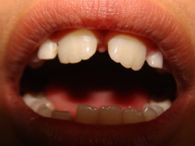 clinical features of mixed dentition period | PPT