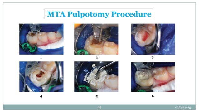 Comparison of Pulpotomy with Formocresol and Mineral Trioxide Aggregate ...