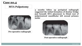 Comparison of Pulpotomy with Formocresol and Mineral Trioxide Aggregate ...