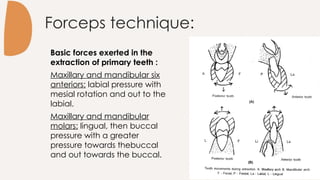 paedodontic extraction of teeth presentation | PPTX