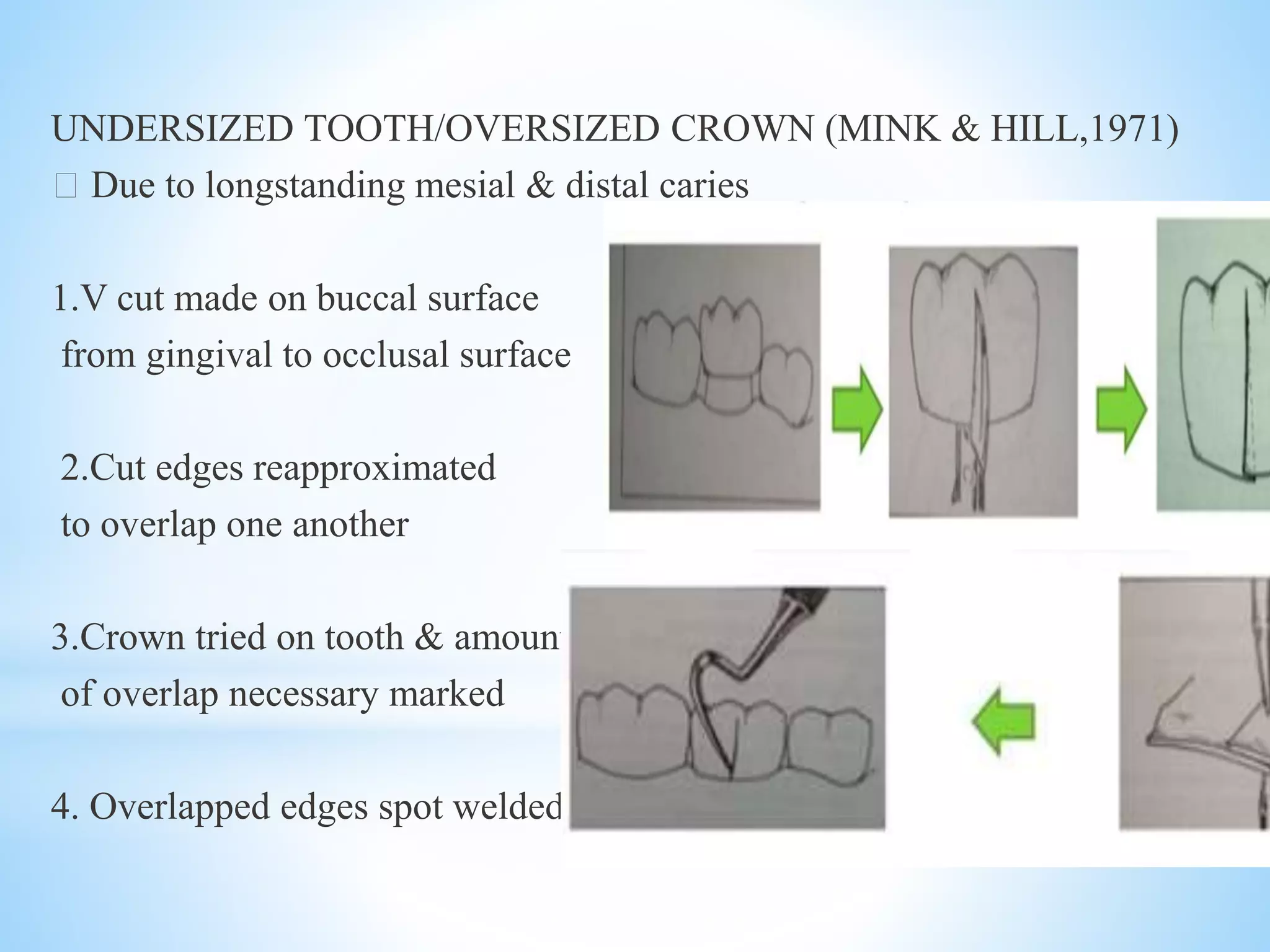 stainless steel crown | PPTX