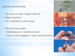 stainless steel crown | PPTX