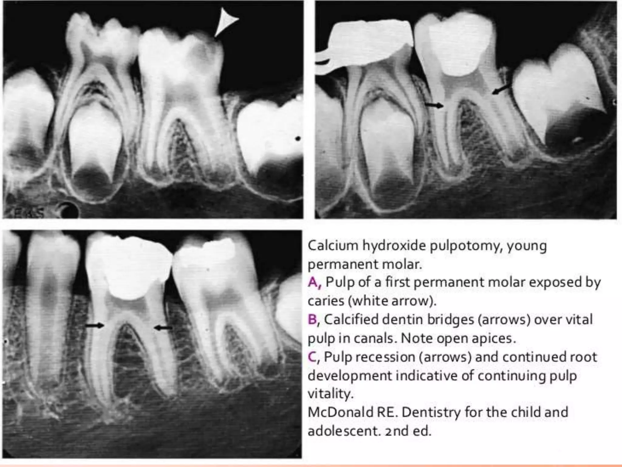 CVEK,S PULPOTOMY | PPTX