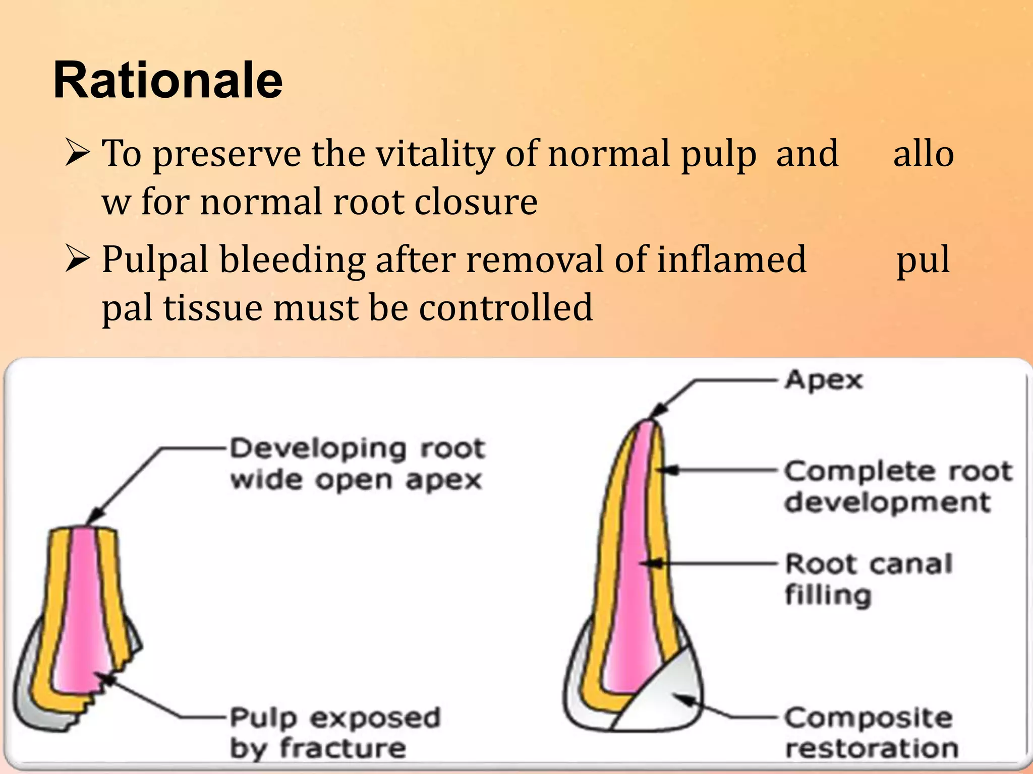 CVEK,S PULPOTOMY | PPTX