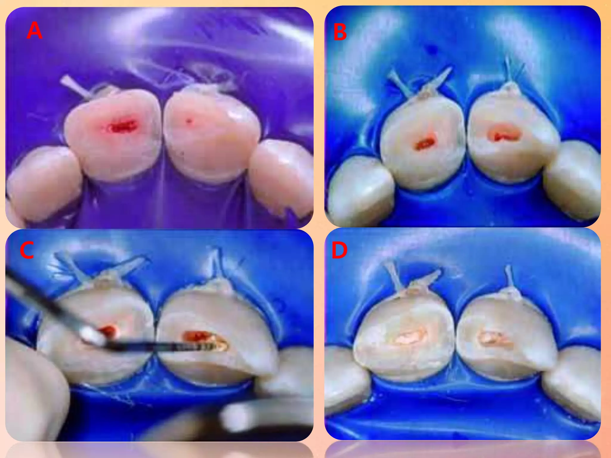 CVEK,S PULPOTOMY | PPTX