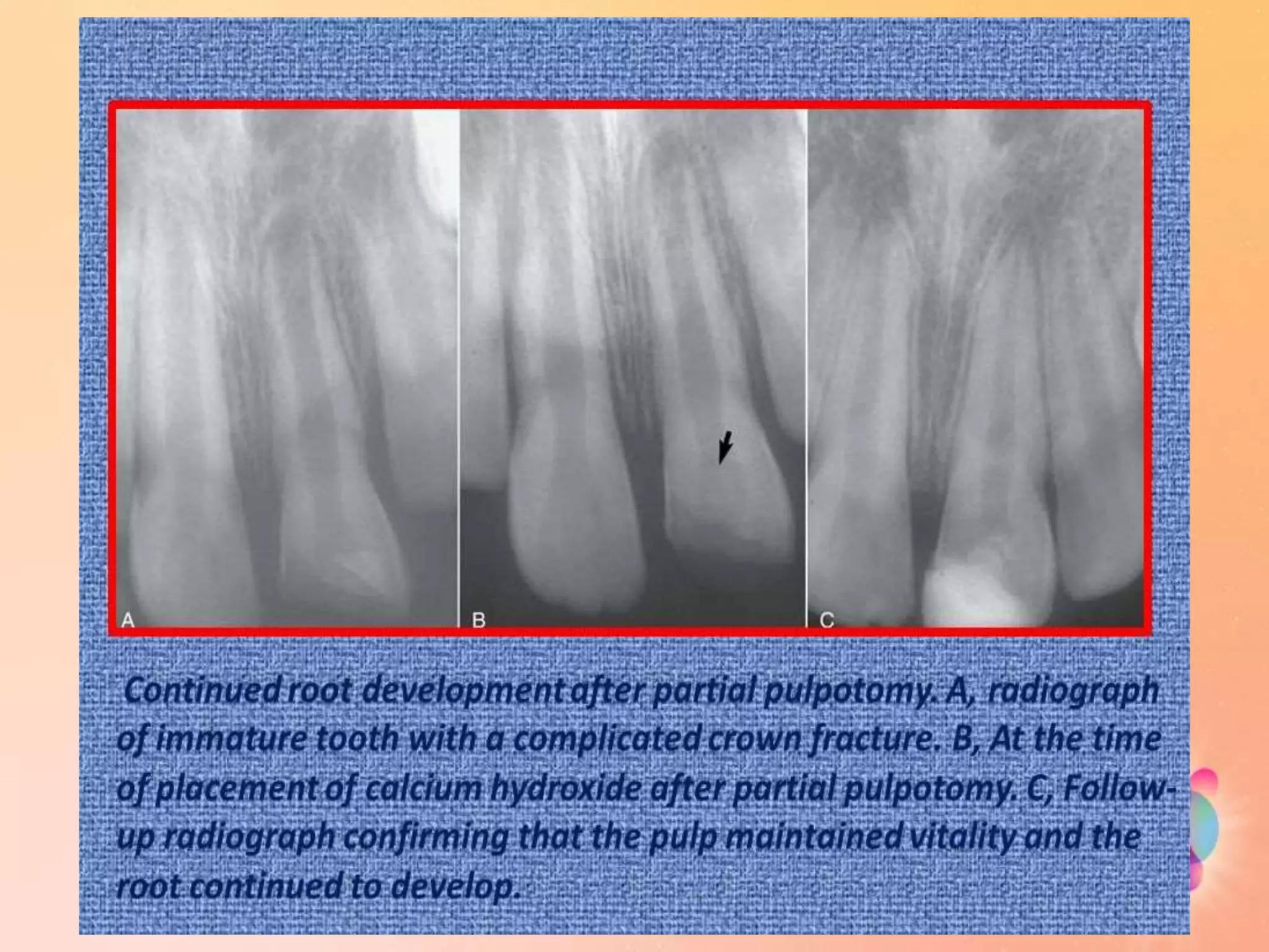 CVEK,S PULPOTOMY | PPTX