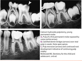 CVEK,S PULPOTOMY | PPTX