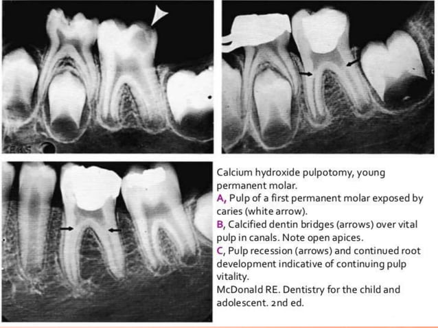 CVEK,S PULPOTOMY | PPTX | Dental Health | Diseases and Conditions