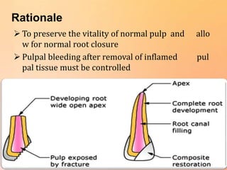 CVEK,S PULPOTOMY | PPTX