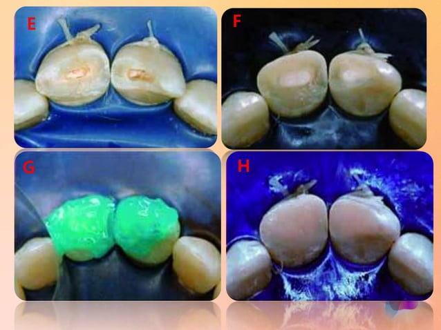 CVEK,S PULPOTOMY | PPTX | Dental Health | Diseases and Conditions