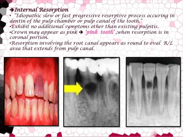 Diagnosis Of Pulpal Pathology In Pedodontics