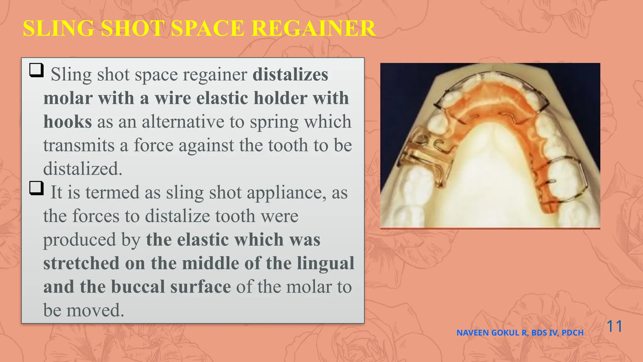 SPACE REGAINERS IN TOOTH LOSS (PEDIATRIC DENTISTRY) | PPTX
