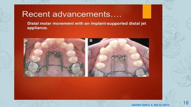 SPACE REGAINERS IN TOOTH LOSS (PEDIATRIC DENTISTRY) | PPTX | Dental ...
