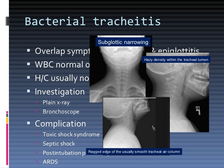 Pediatric respiratory emergency : upper