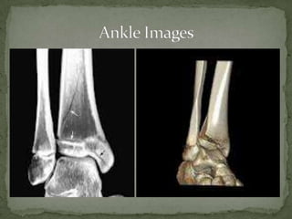 Triplane Fracture | PPTX