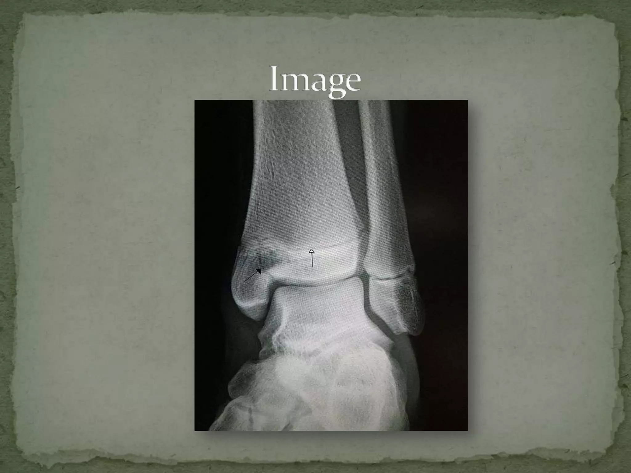 Salter Harris Type 3 Fracture | PPTX