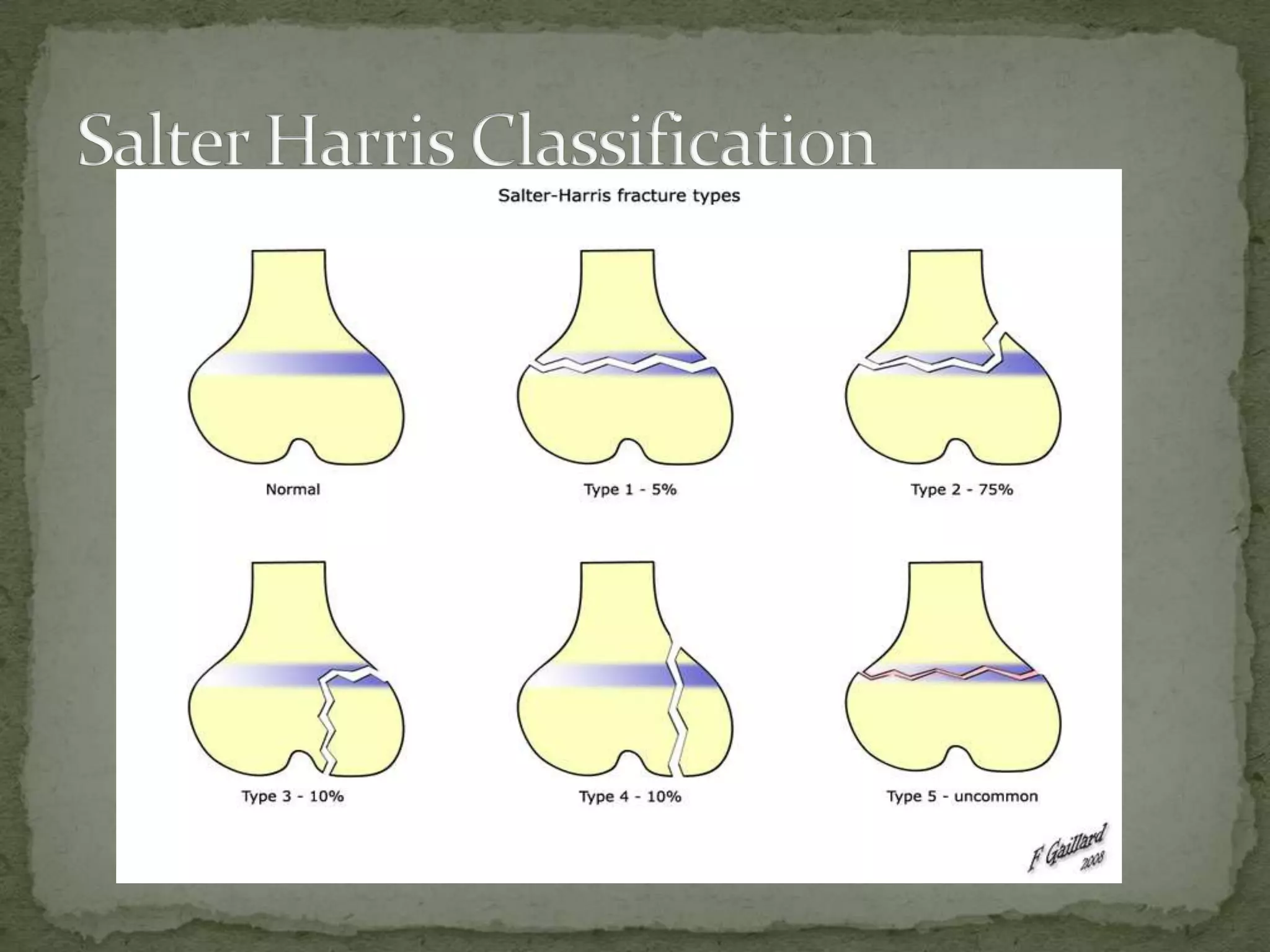 Salter Harris Type 3 Fracture | PPTX