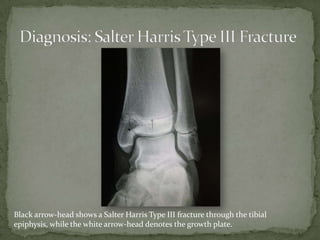 Salter Harris Type 3 Fracture | PPTX