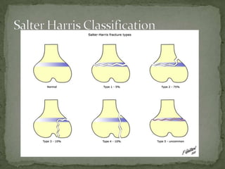 Salter Harris Type 3 Fracture | PPTX