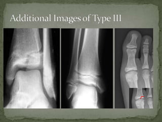 Salter Harris Type 3 Fracture
