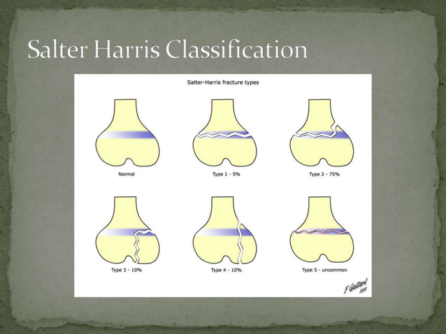 Salter Harris Type 5 Fracture | PPTX
