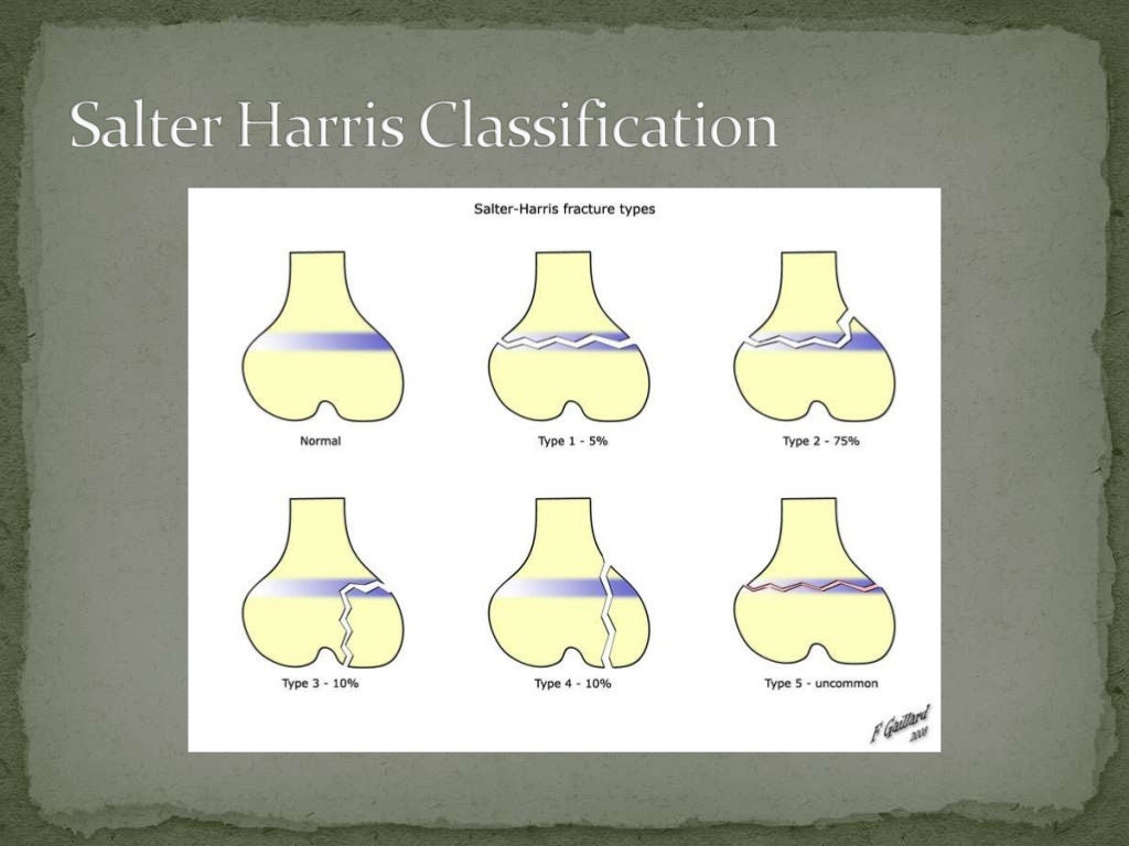 Salter Harris Type 5 Fracture