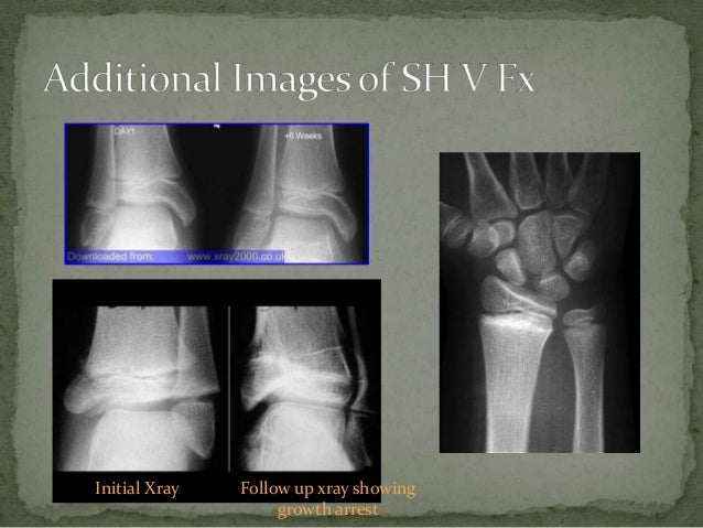 Salter Harris Type 5 Fracture