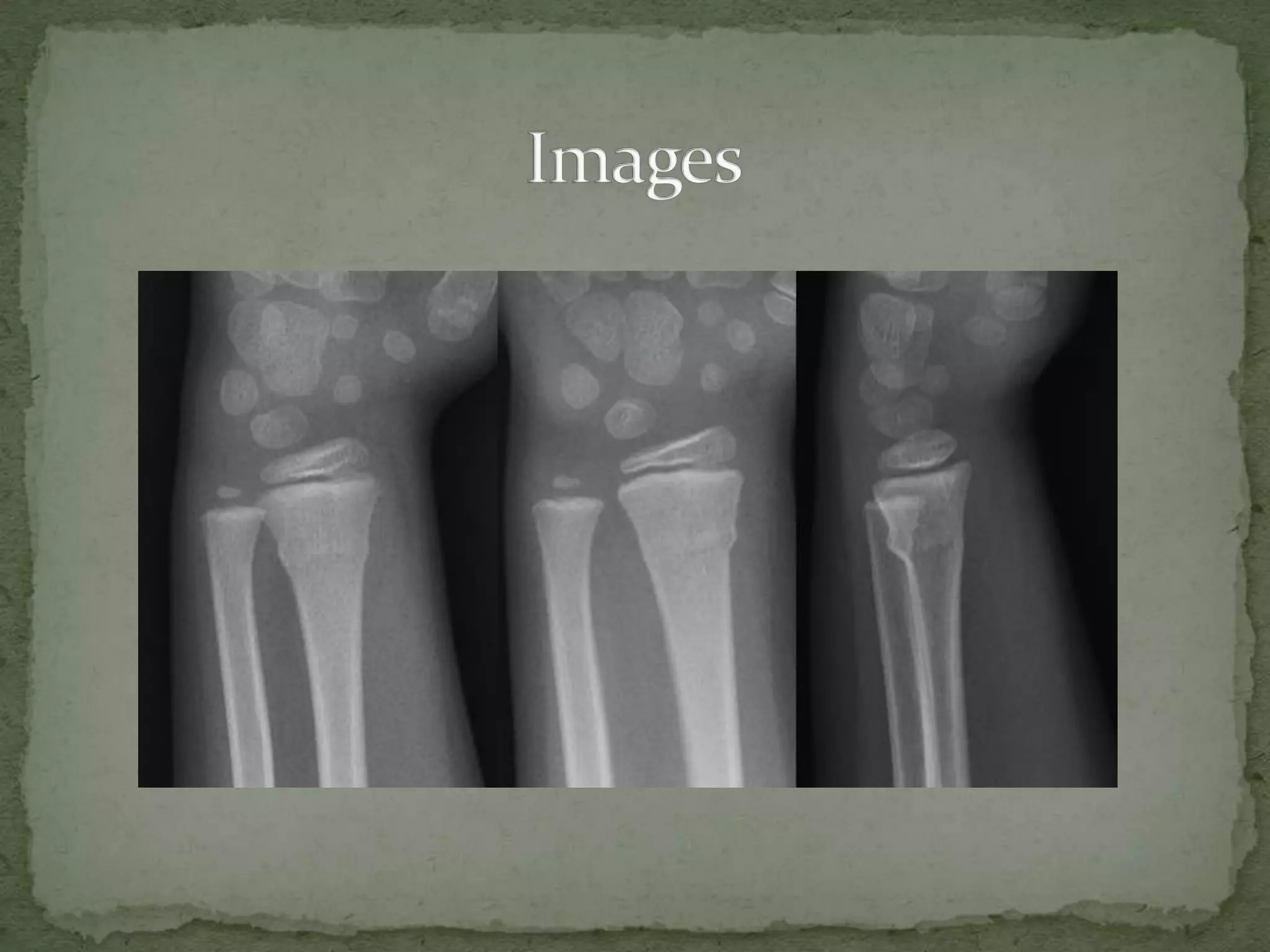 Torus Fracture | PPTX