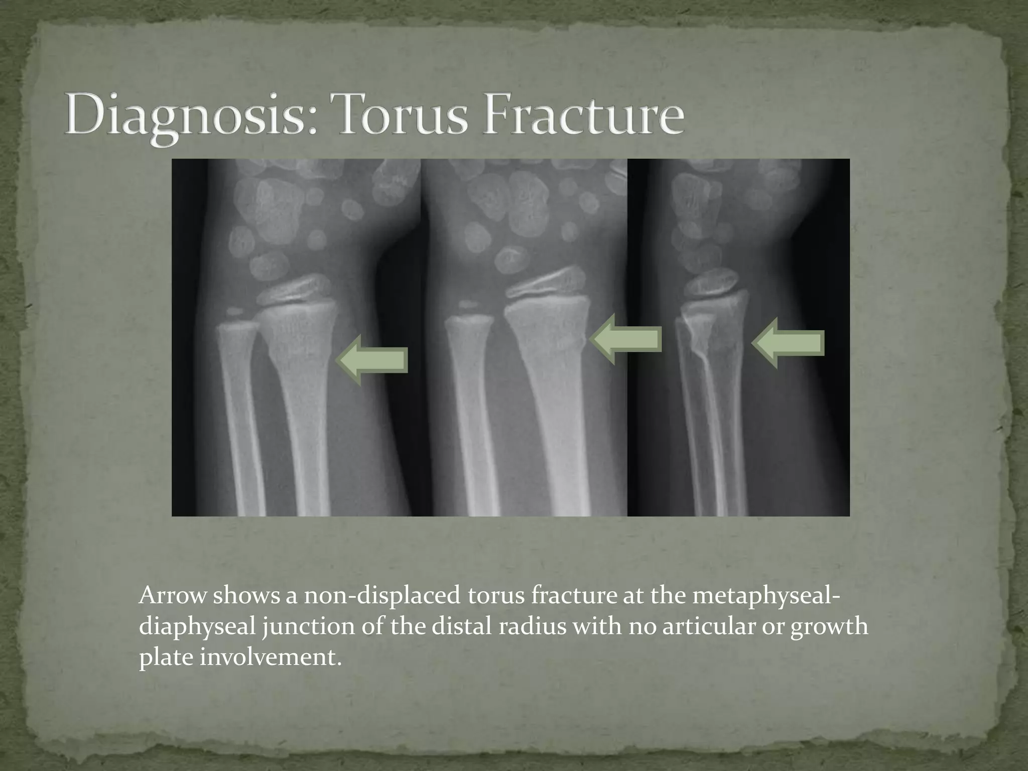 Torus Fracture | PPTX