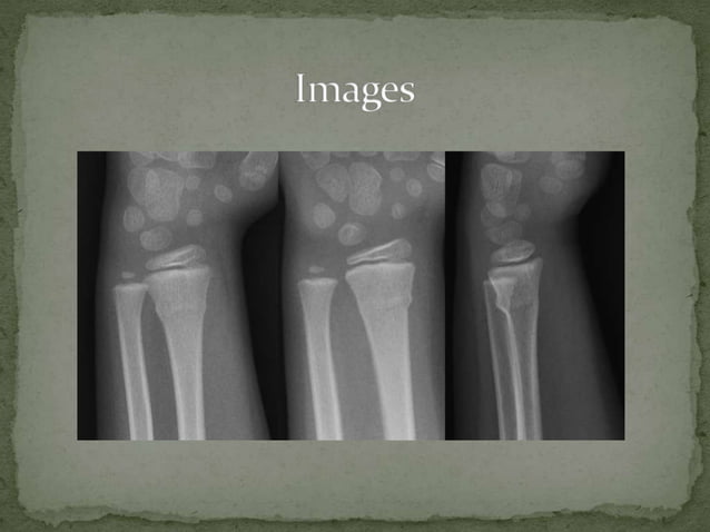 Torus Fracture | PPTX