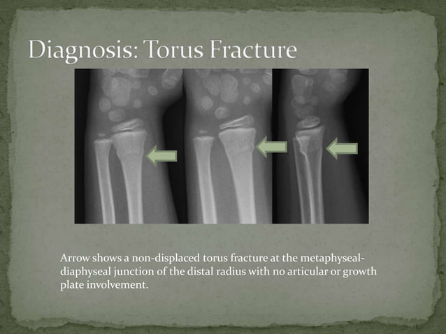 Torus Fracture | PPTX