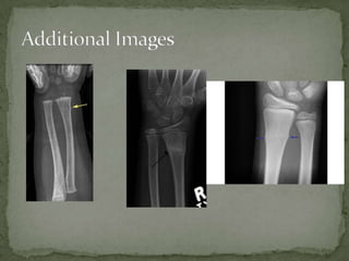 Torus Fracture | PPTX