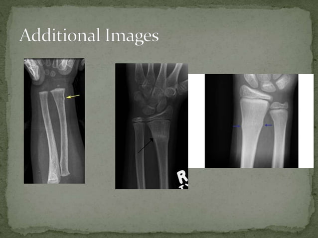 Torus Fracture | PPTX