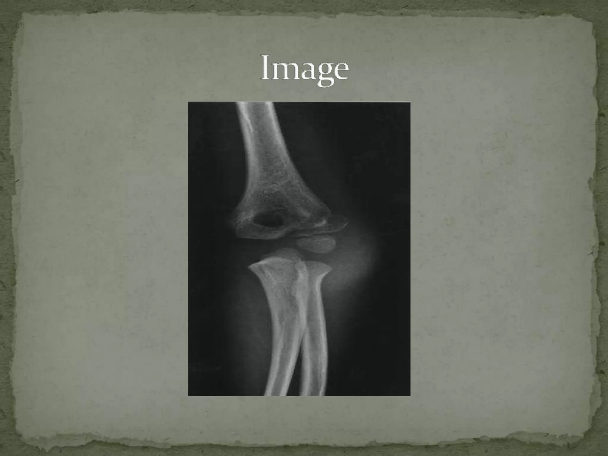 Lateral Humeral Condyle Fracture | PPT