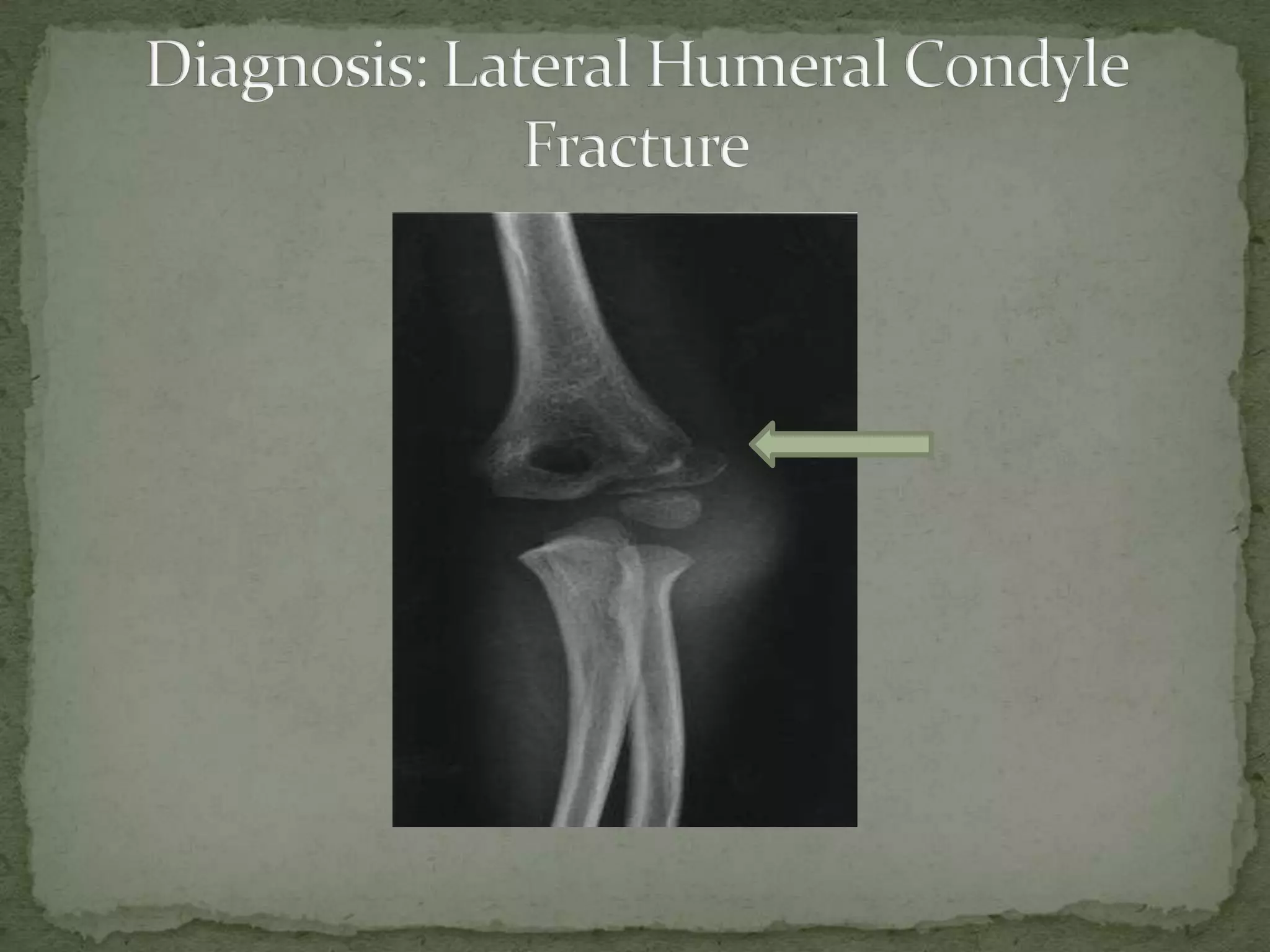Lateral Humeral Condyle Fracture | PPT