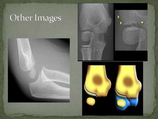 Lateral Humeral Condyle Fracture | PPT
