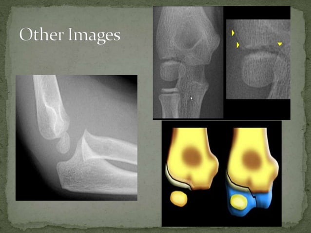 Lateral Humeral Condyle Fracture | PPT