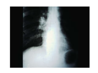 Childhood Tuberculosis and Community Healthcare_Alan Talens_5.8.14