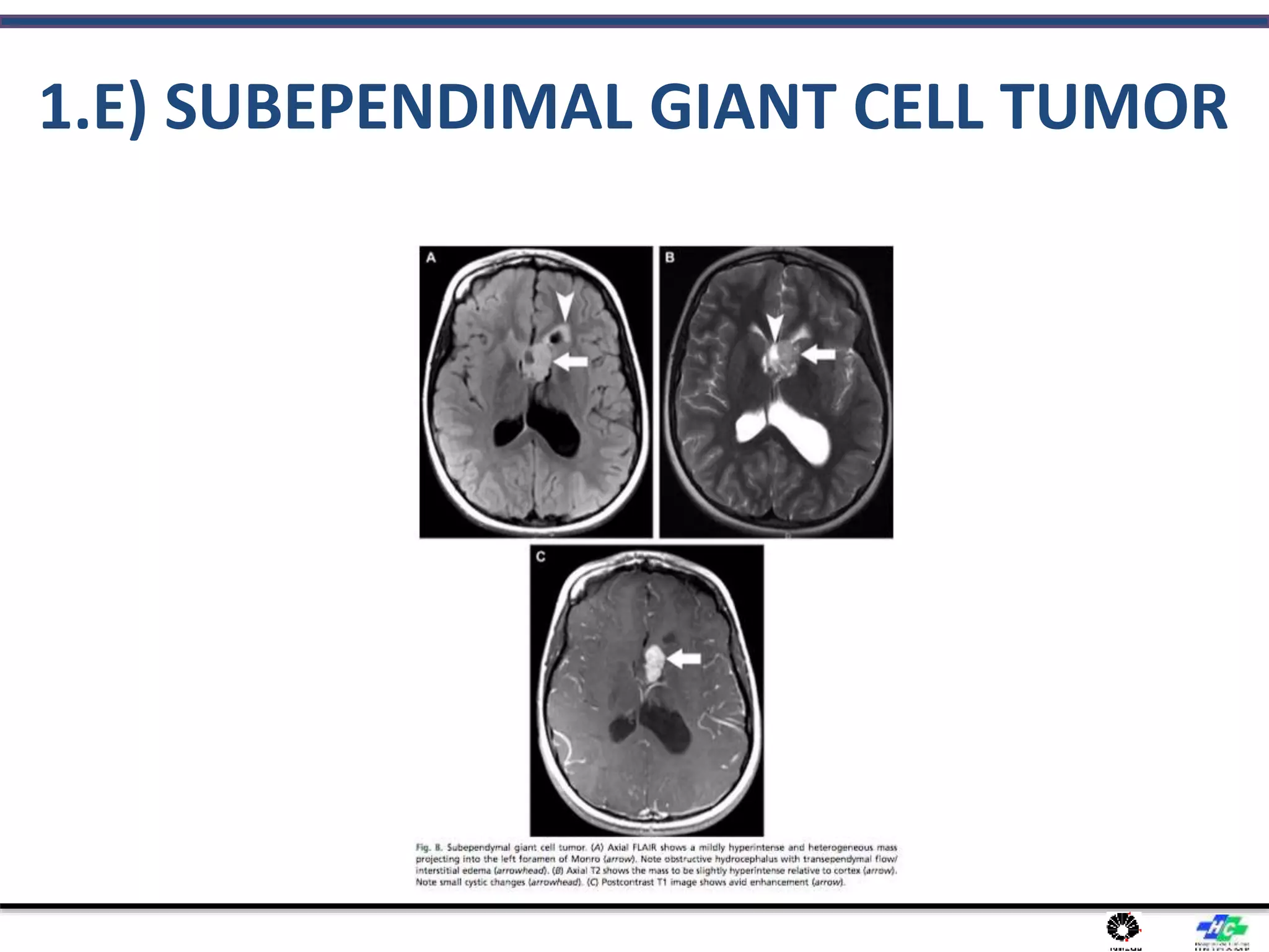 Pediatric Supratentorial Tumors / Tumores Supratentoriais Pediátrico | PPTX