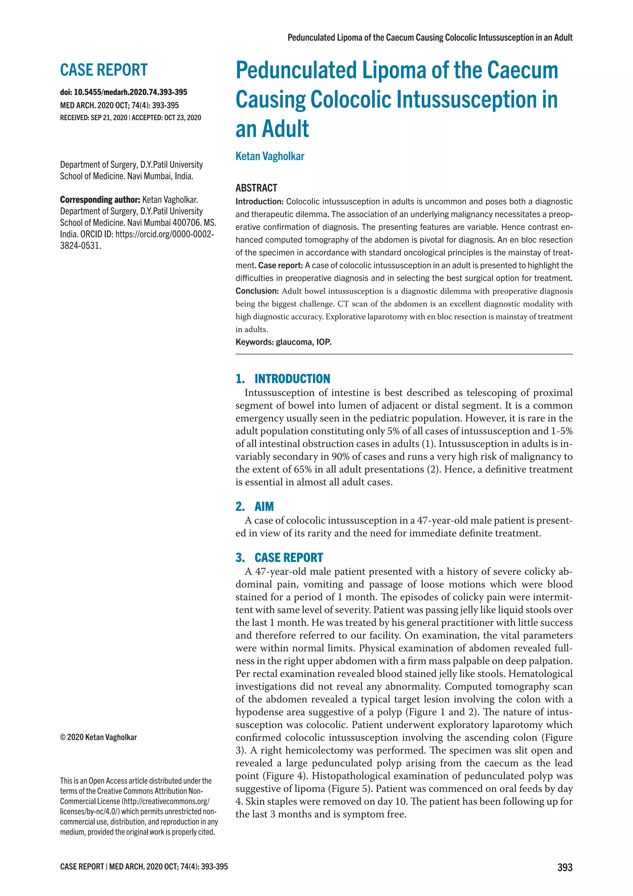 Pedunculated Lipoma of the Caecum Causing Colocolic Intussusception in ...
