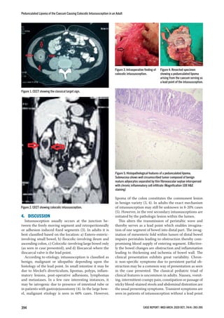 Pedunculated Lipoma of the Caecum Causing Colocolic Intussusception in ...