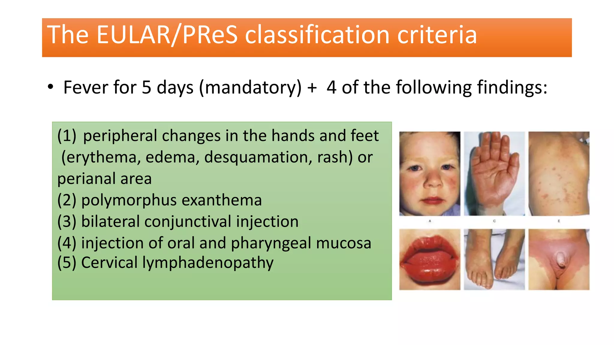 Pediatric vasculitis | PPTX