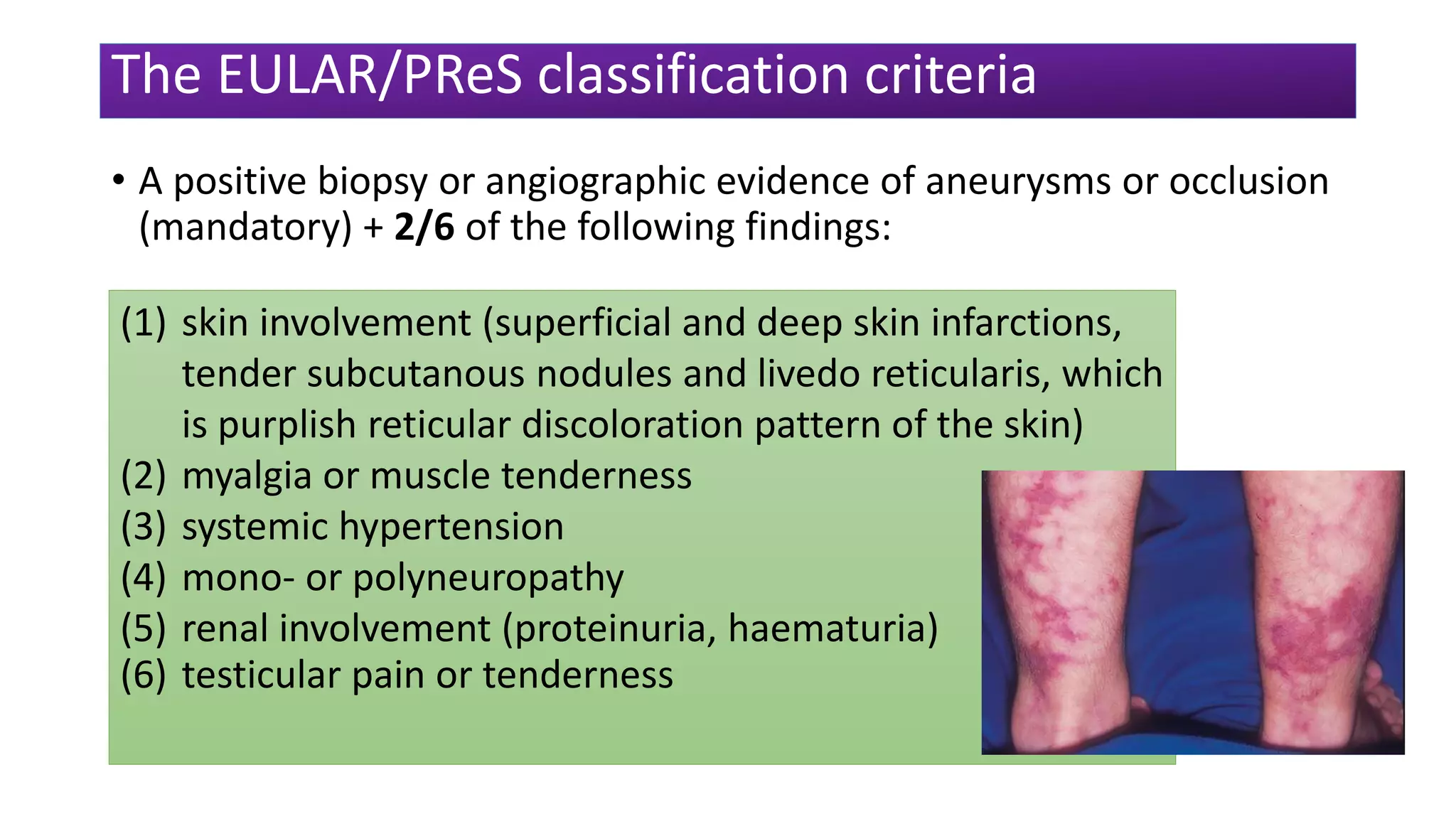 Pediatric vasculitis | PPTX
