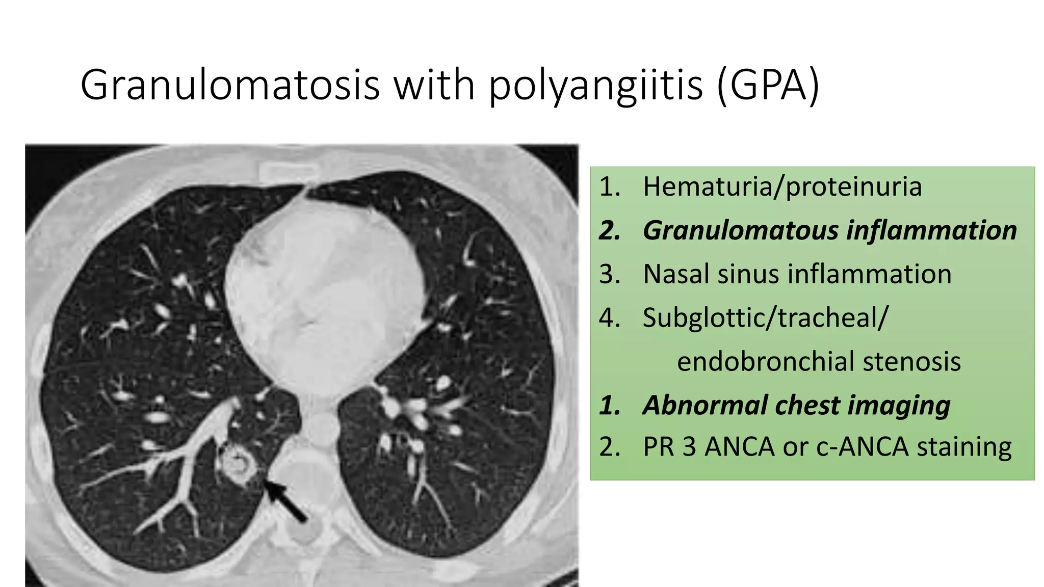 Pediatric vasculitis | PPTX