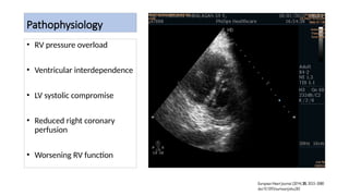 Pulmonary Embolism in Emergency Medicine .pptx