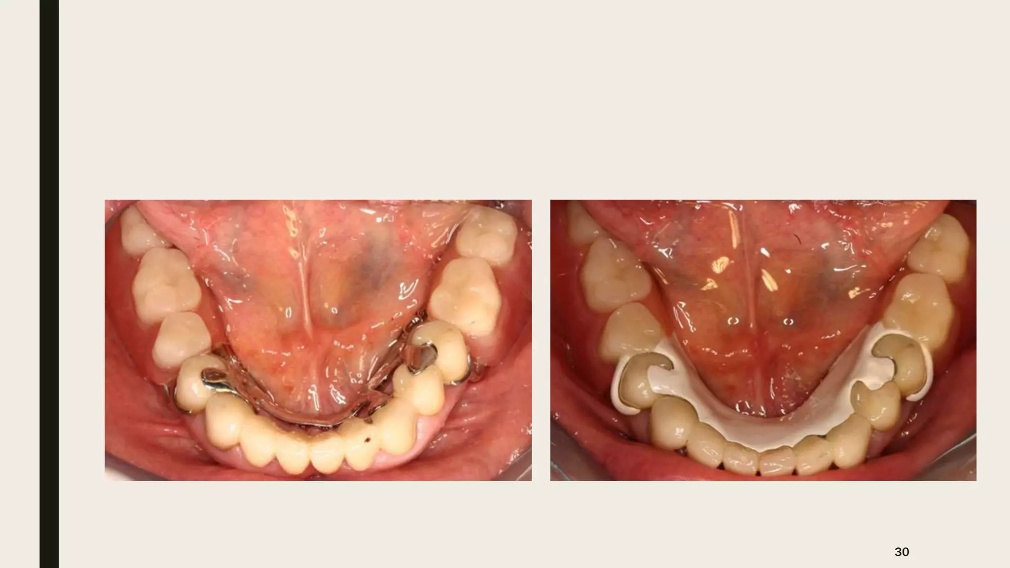 PEEK :Polyetheretherketone applications in clinical dentistry | PPTX